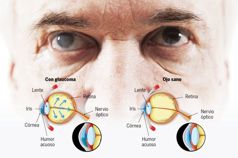 Identifican Proteínas Para El Diagnóstico Temprano Del Glaucoma